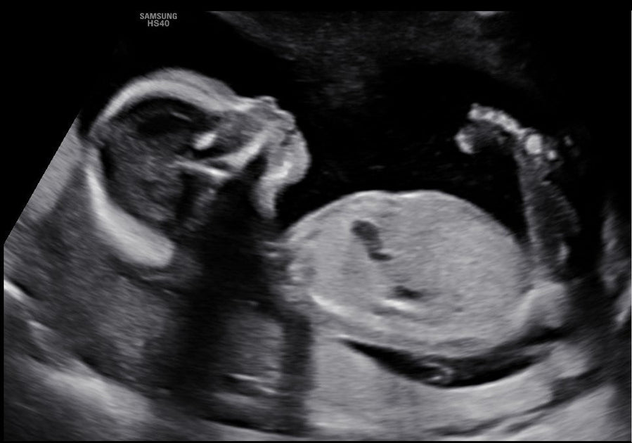 Fetal Anatomy Scan – Starlight